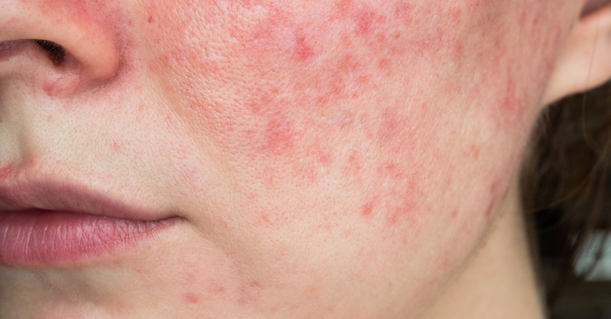 Mild Rosacea Cheeks